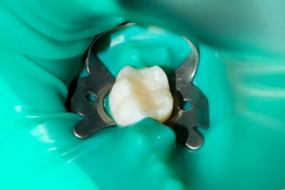 What Is A Dental Dam? | Evergreen Dental Arts | San Jose, CA